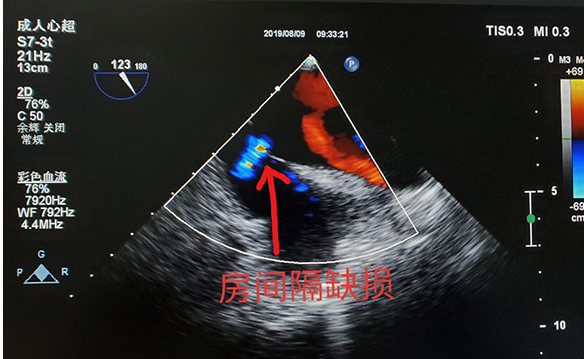 TEE是什么医学检查-百度经验